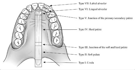 The Pittsburgh Fistula Classification System According To Smith Et Al
