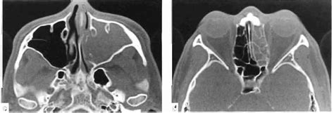 A Typical Case Of Type 3 Sinusitis A Panoramic Radiograph There Are