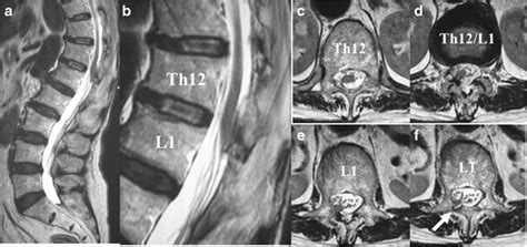 Mri Of The Thoracolumbar Spine Of A 74 Year Old Female Views A