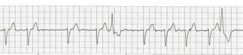 Ekg Rhythm Strip Quiz 90