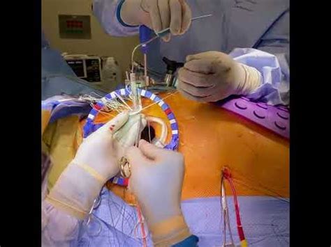 Minimally Invasive Mitral Valve Repair Youtube