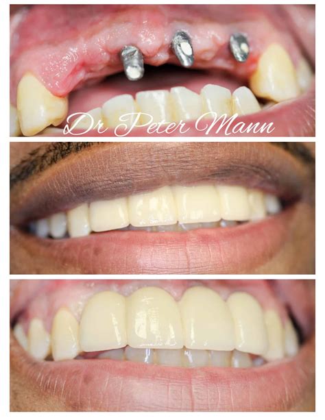 Dental Implants Gone Wrong Dental Implants Gone Wrong