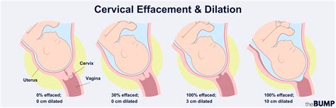 Pregnancy Effacement Chart Induction Of Labor Ohio Birth Injury