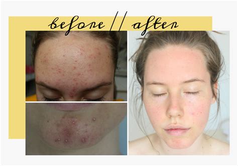 Medical Medium Acne Protocol Hd Png Download Kindpng