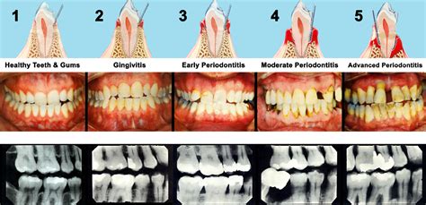 Mild Periodontitis