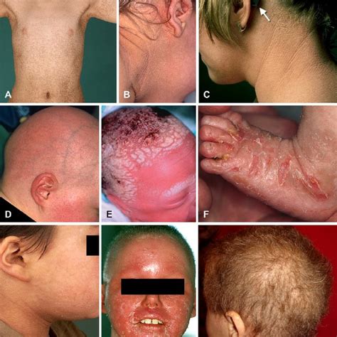 Clinical Examples Of Autosomal Recessive Congenital Ichthyosis