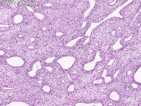 Spindle Cell Lipoma Vascularity