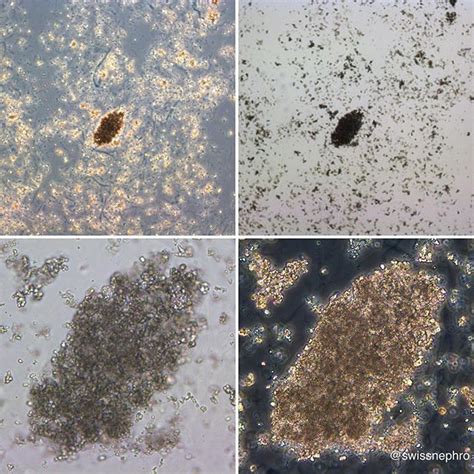 Abundant Amorphous Phosphate With A Pseudocast Phase Contrast Bright