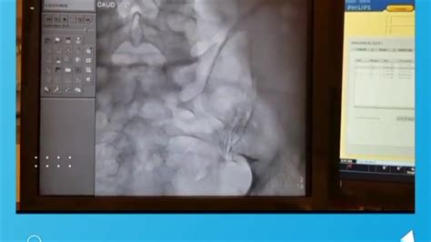 خارج کردن فیلتر ورید اجوف تحتانی نماشا