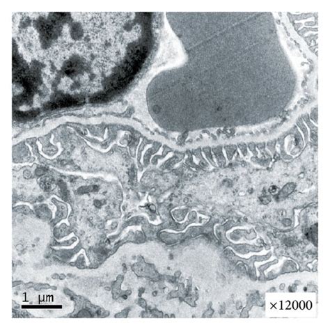 Electron Microscopy Irregular Thickening Of The Gbm And The Fusion Of Download Scientific