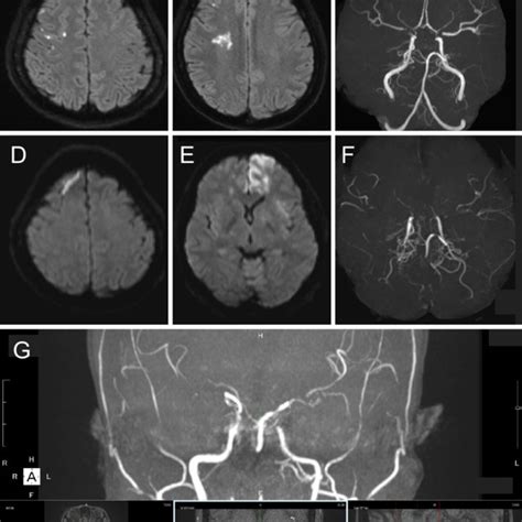 Figure2diffusion Weighted Brain Magnetic Resonance Imaging Mri A