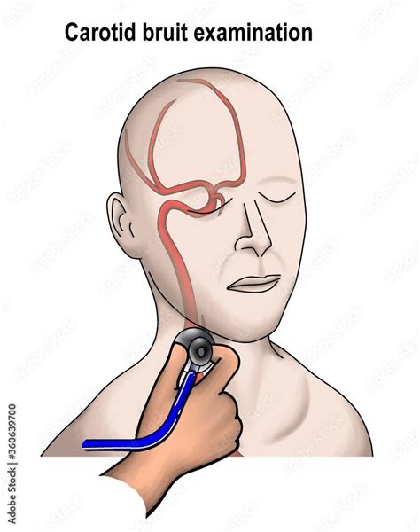The Physcial Examination Of Right Carotid Bruit Which Is The