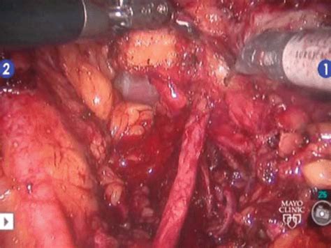Robotic Radical Parametrectomy In Benign Disease Report Of Two Cases