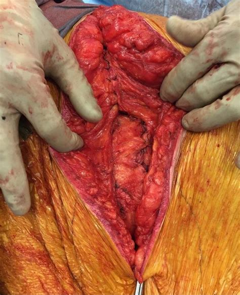 Reduction Of Hernia Content And Primary Closure Of The Defect