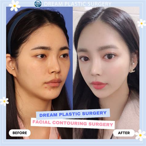 Plastic Surgery Before And After [dream Plastic Surgery Korea] Asian