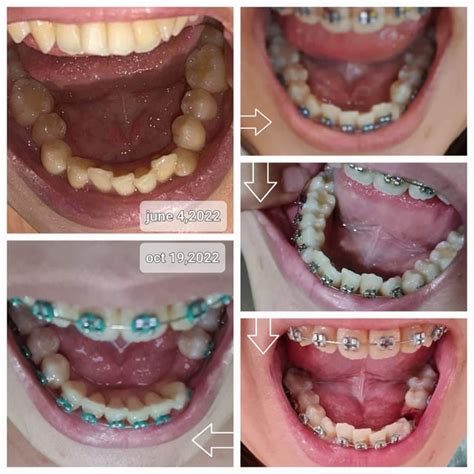 5th Month Today Power Braces For The First Time R Braces