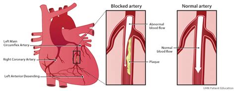 Angina Cardiac College