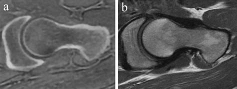 Zero Echo Time Zte Versus Proton Density Weighted Images Swiss Axial