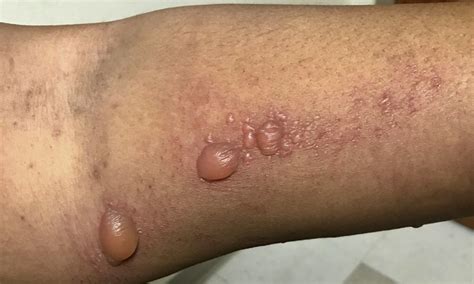 Tense Bullae As A Rare Skin Manifestation Of Hereditary Angioedema