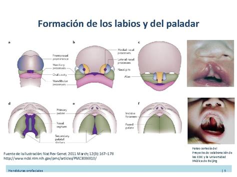 Hendiduras Orofaciales Descargo De Responsabilidad Los Hallazgos Y