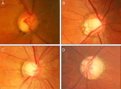 Peripapillary Atrophy In Glaucoma