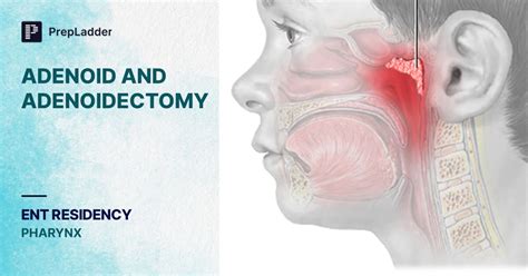 Adenoid And Adenoidectomy Causes Symptoms And Treatment