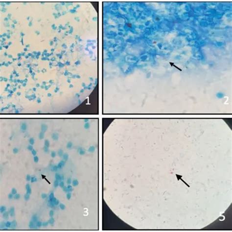 Cerebrospinal Fluid Csf For Afb Stain Test In Delhi Ncr India Gdic