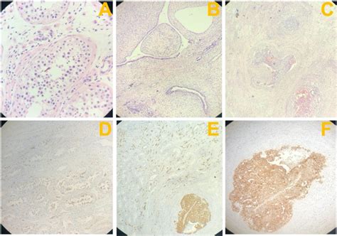 Histopathologic Sections Of The Mixed Germinal Testicular Tumor A