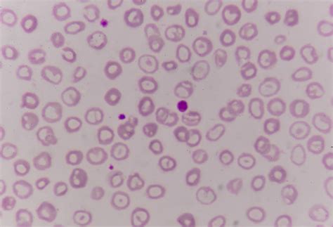 What Does It Mean If Plateletcrit Value Is High