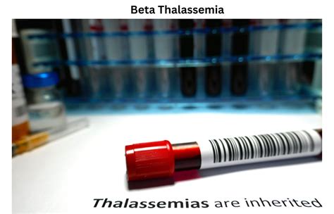 Living With Beta Thalassemia Major Challenges And Coping Tips