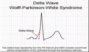 Wolff Parkinson White Syndrome Wpw Treatments Patients And Families