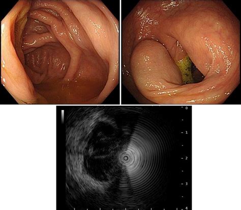 Colonoscopy Findings A Total Colonoscopy Revealing No Mucosal