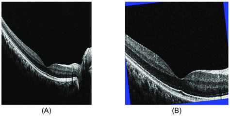 Data Augmentation For Training The Cnn Model Original Oct Image A Download Scientific