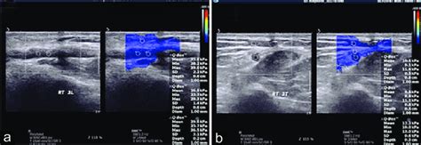 Elastogram Map Images Showing The Shear Wave Elastography Box Placement