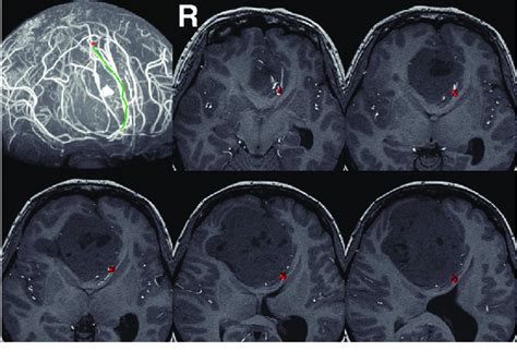 Case 3 A 29 Year Old Woman With Transitional Meningioma The Green
