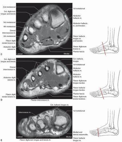 Plantar Foot Muscles Mri