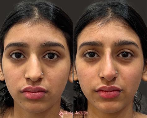 Non Surgical Rhinoplasty Before And After Results