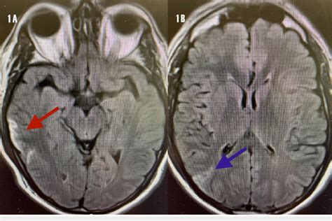 Flair Mri A Right Cortical Temporal Ischemic Infarct Red Arrow