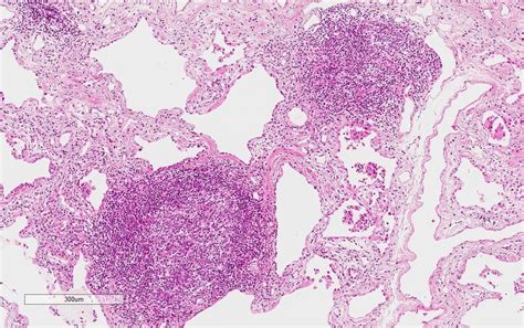 Pathology Outlines Interstitial Pneumonia With Autoimmune Features