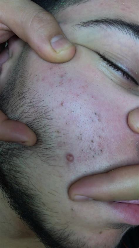 Pin On Blackheads Removal