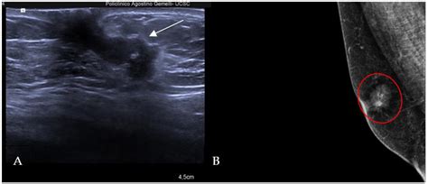 Male Gynecomastia Ultrasound Radiology