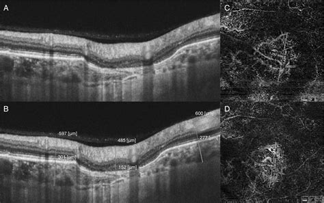 Osteoma De Coroides Con Excavación Coroidea Y Membrana Neovascular Asociada Estudio Mediante