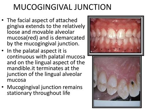 Gingiva Pptx