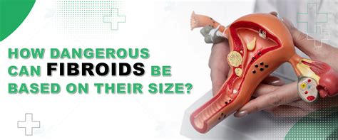 Large Uterus Fibroid