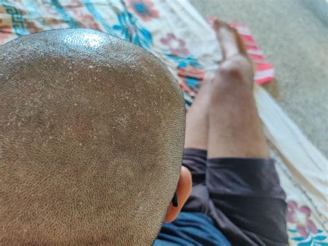 Skin Has Red Patches And It Flakes Continuosly This Is 2 Hours