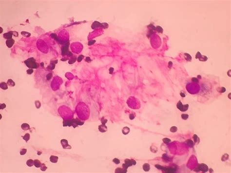The Histopathologic Evaluation Showed An Atypical Osteoblastic