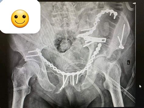 Ilir Hasani On Linkedin Complex Pelvi Acetabular Fracture Solved With A Smiley