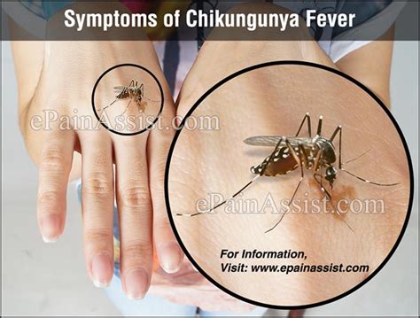 Is Chikungunya Contagious Know The Symptoms Spread Treatment Homeopathic Remedies For