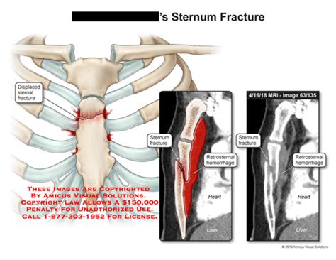 Sternum Fracture
