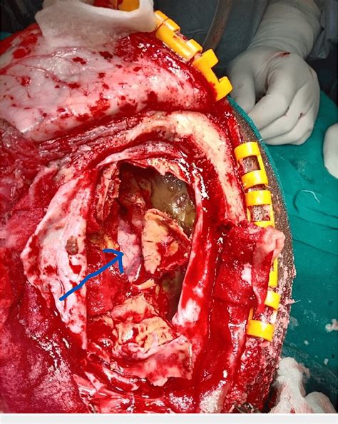 Figure 1 From Bone Within Bone As A Calcified Subdural Hematoma